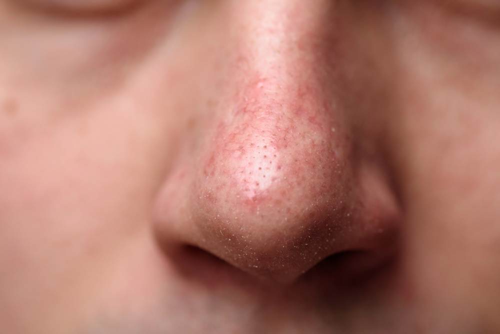 Nose Spots and Bumps: Causes and Treatment Options - IAPAM